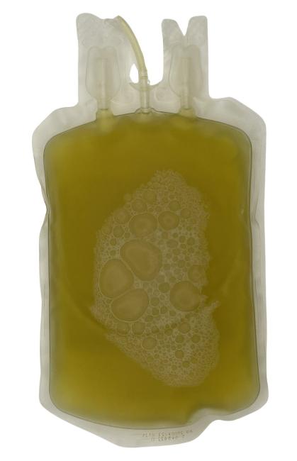 Plasma: Other causes of discolouration | Professional Education