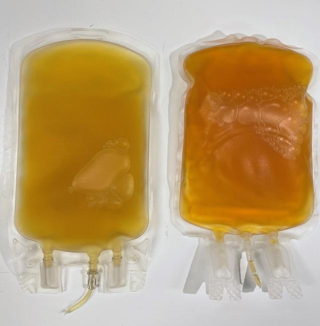 Plasma: Red blood cell contamination | Professional Education