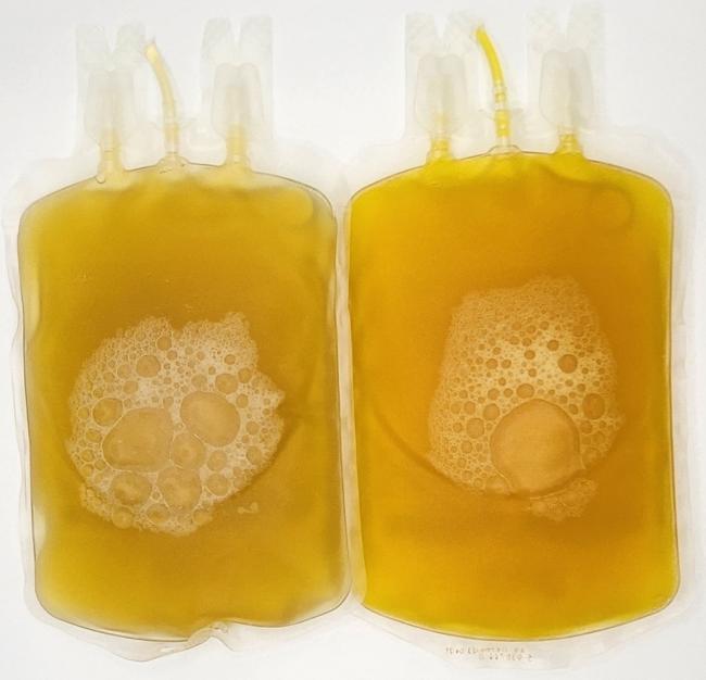 Plasma: Lipemia | Professional Education